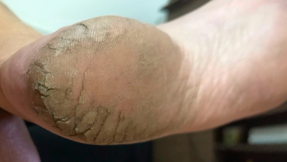 Kit Podol 3 Aplicações (Amolecedor + Hidratante + Espátula)